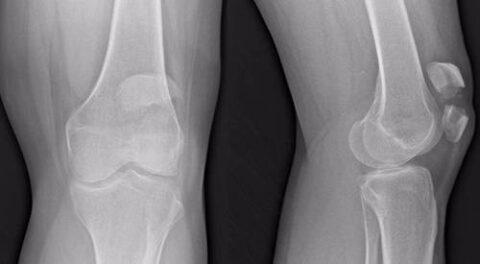 Fracturas de rótula: causas, diagnóstico y tratamiento