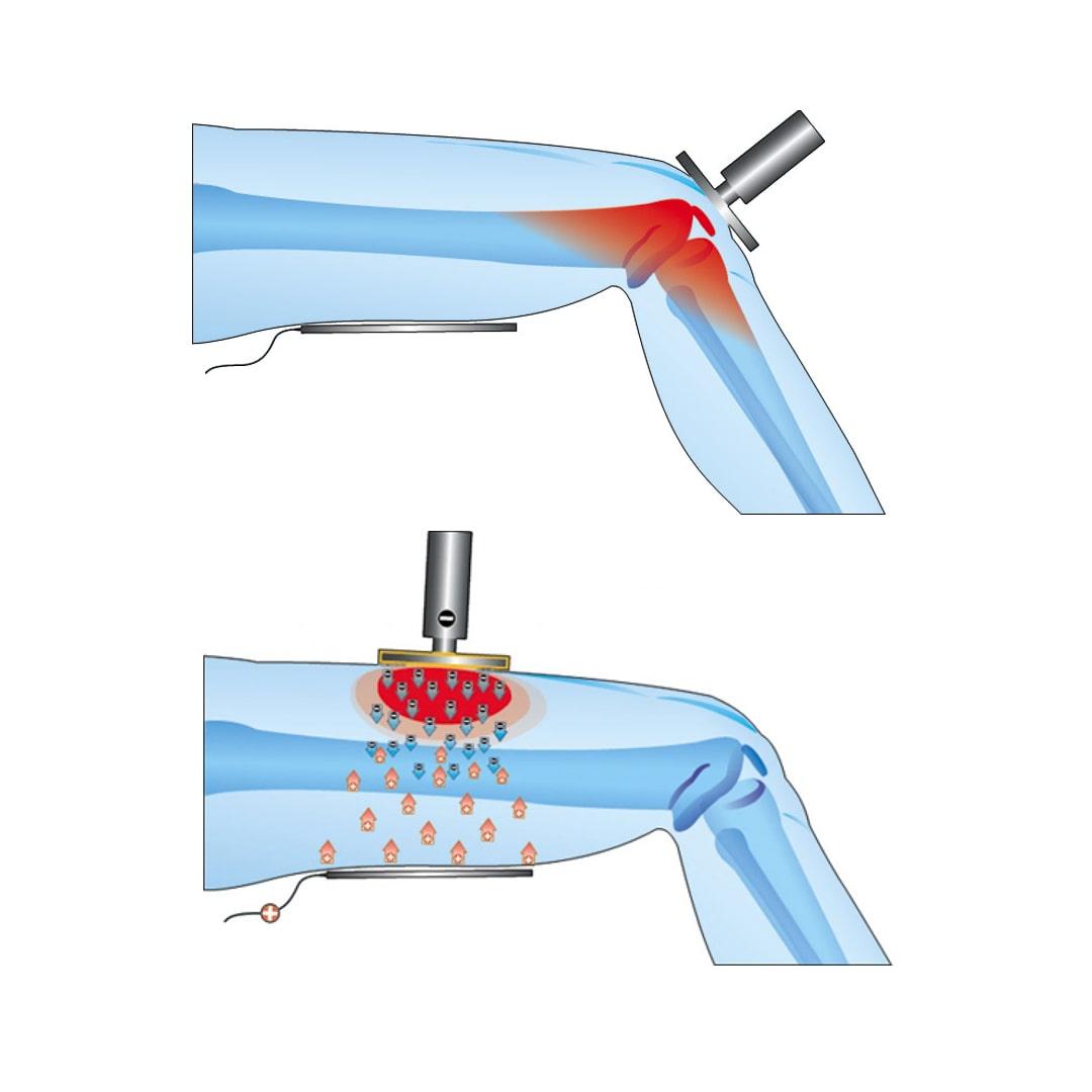 Cómo la Tecarterapia puede mejorar la movilidad y reducir el dolor en ...
