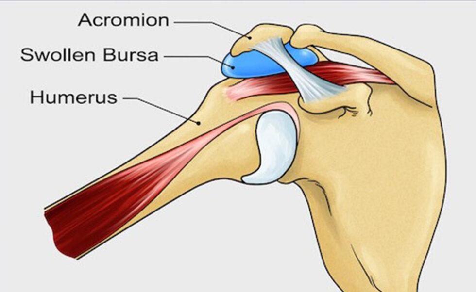 Bursitis Subacromial: Causas, Síntomas, Tratamiento y Prevención - Pmedic